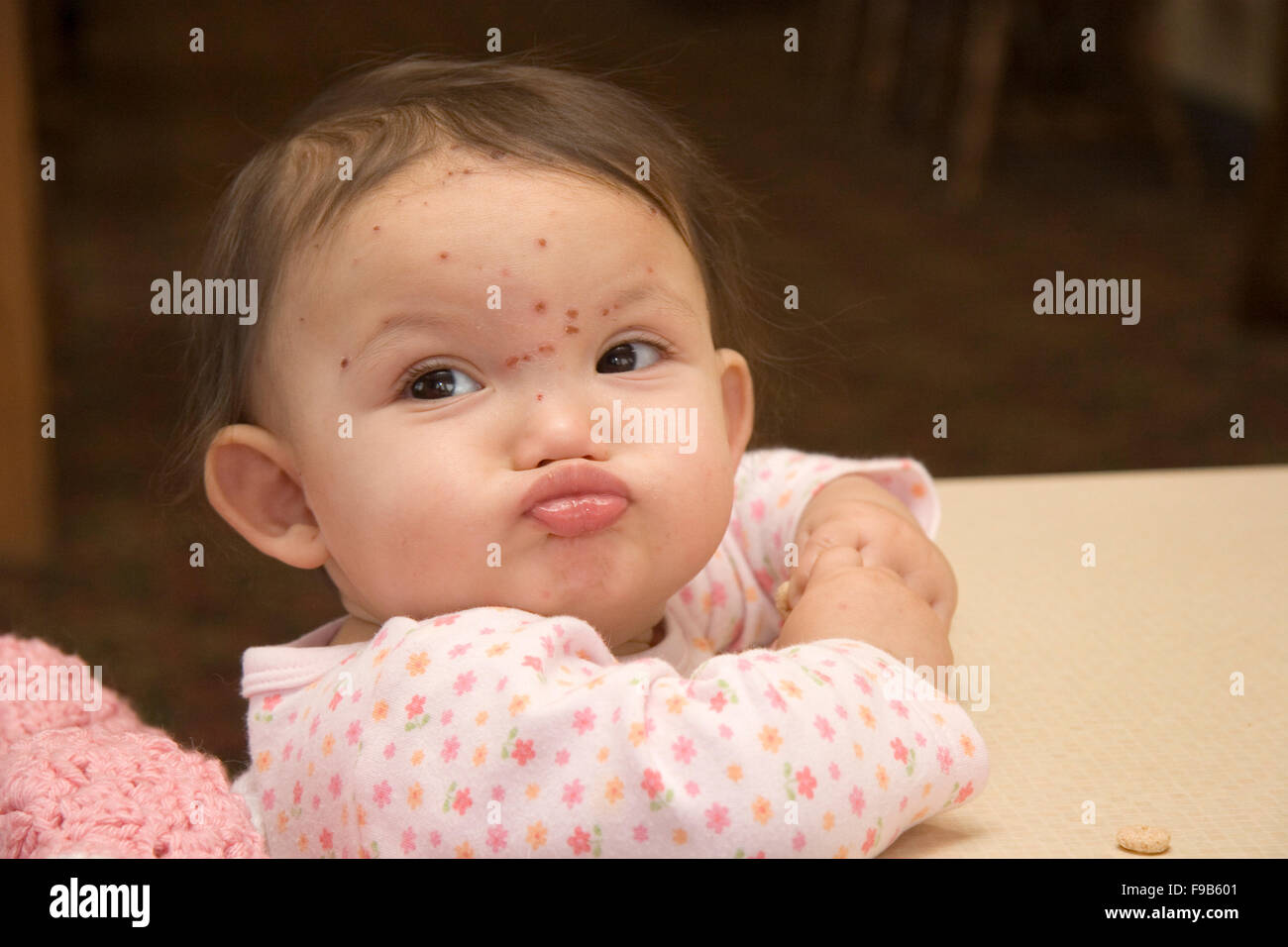 Ten month old girl with chickenpox scabs Stock Photo - Alamy