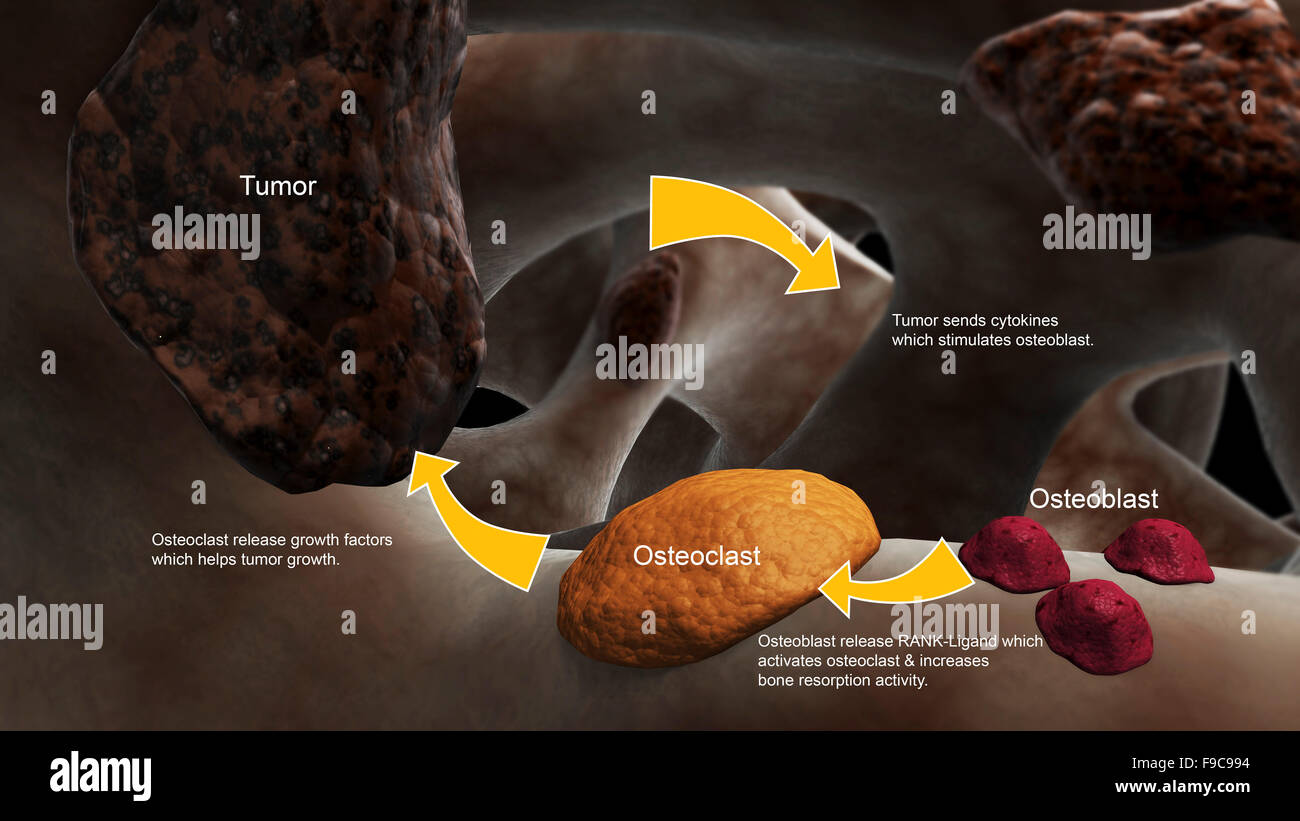 Conceptual image illustrating the process of bone metastasis Stock ...