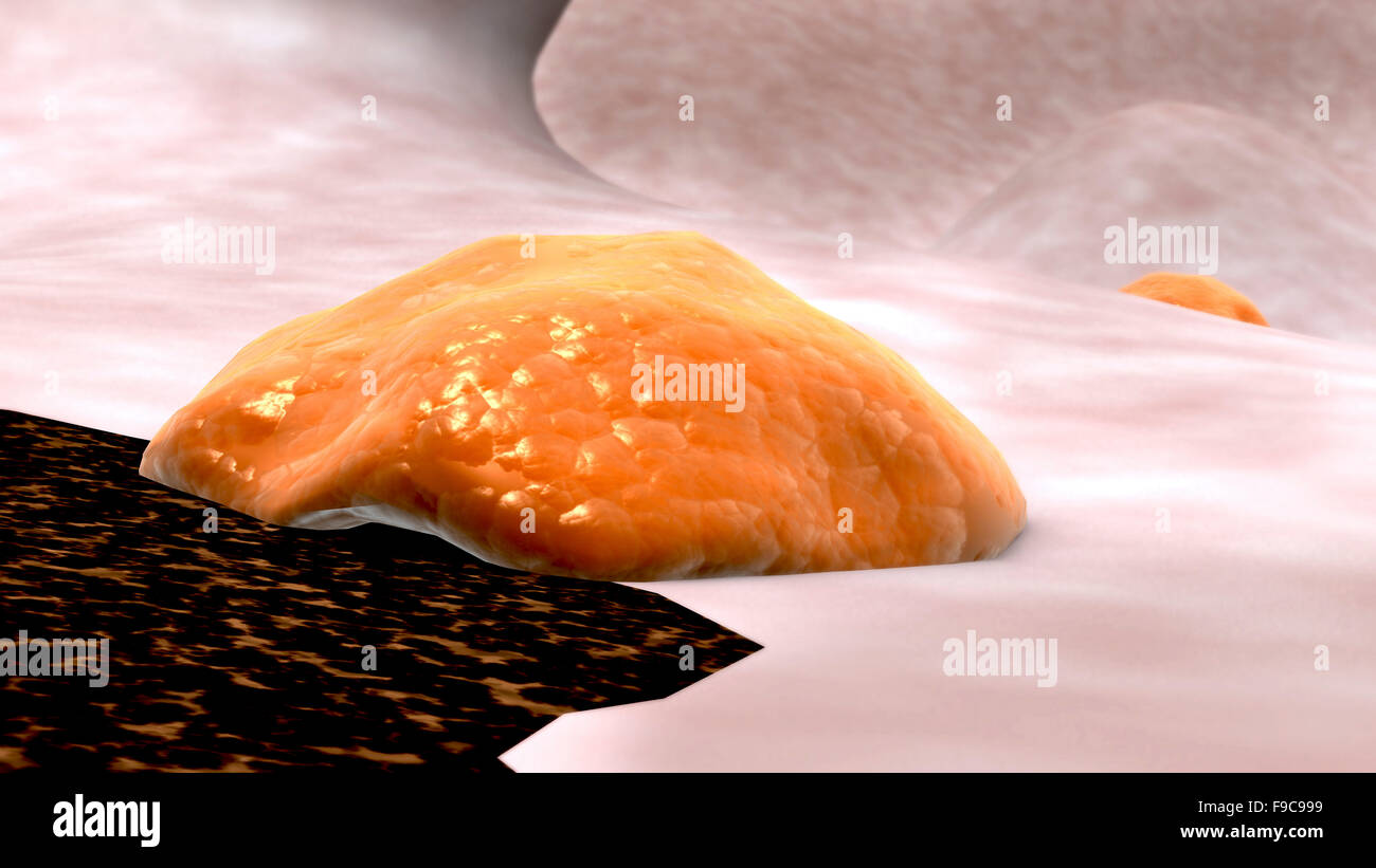 Osteoclast breaking down bone tissue Stock Photo - Alamy