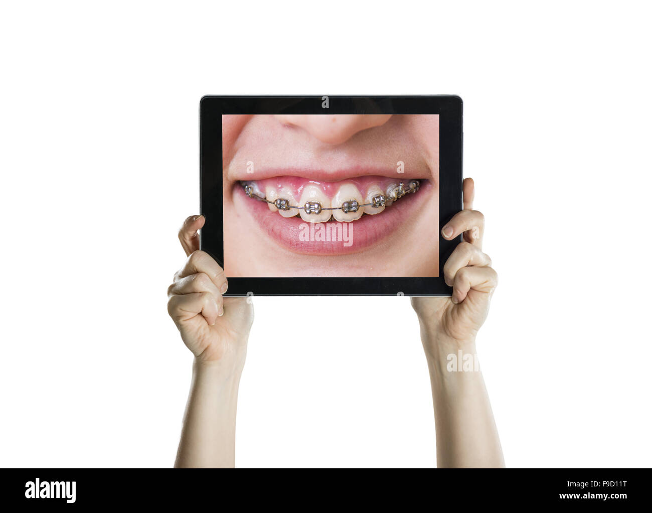 Dental brace hi-res stock photography and images - Alamy