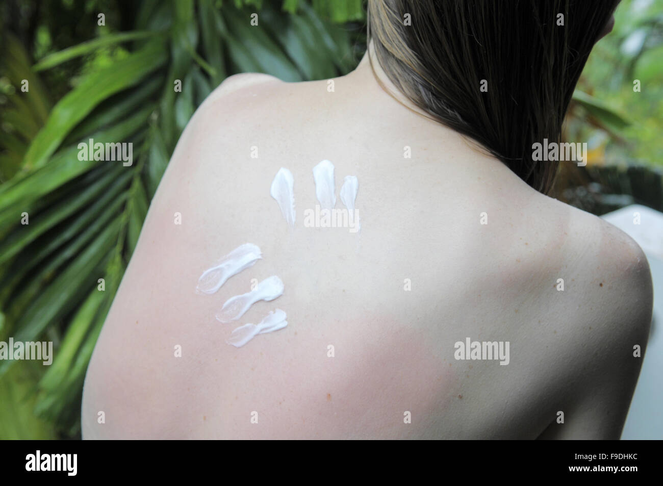 Sunburn back hi-res stock photography and images - Alamy