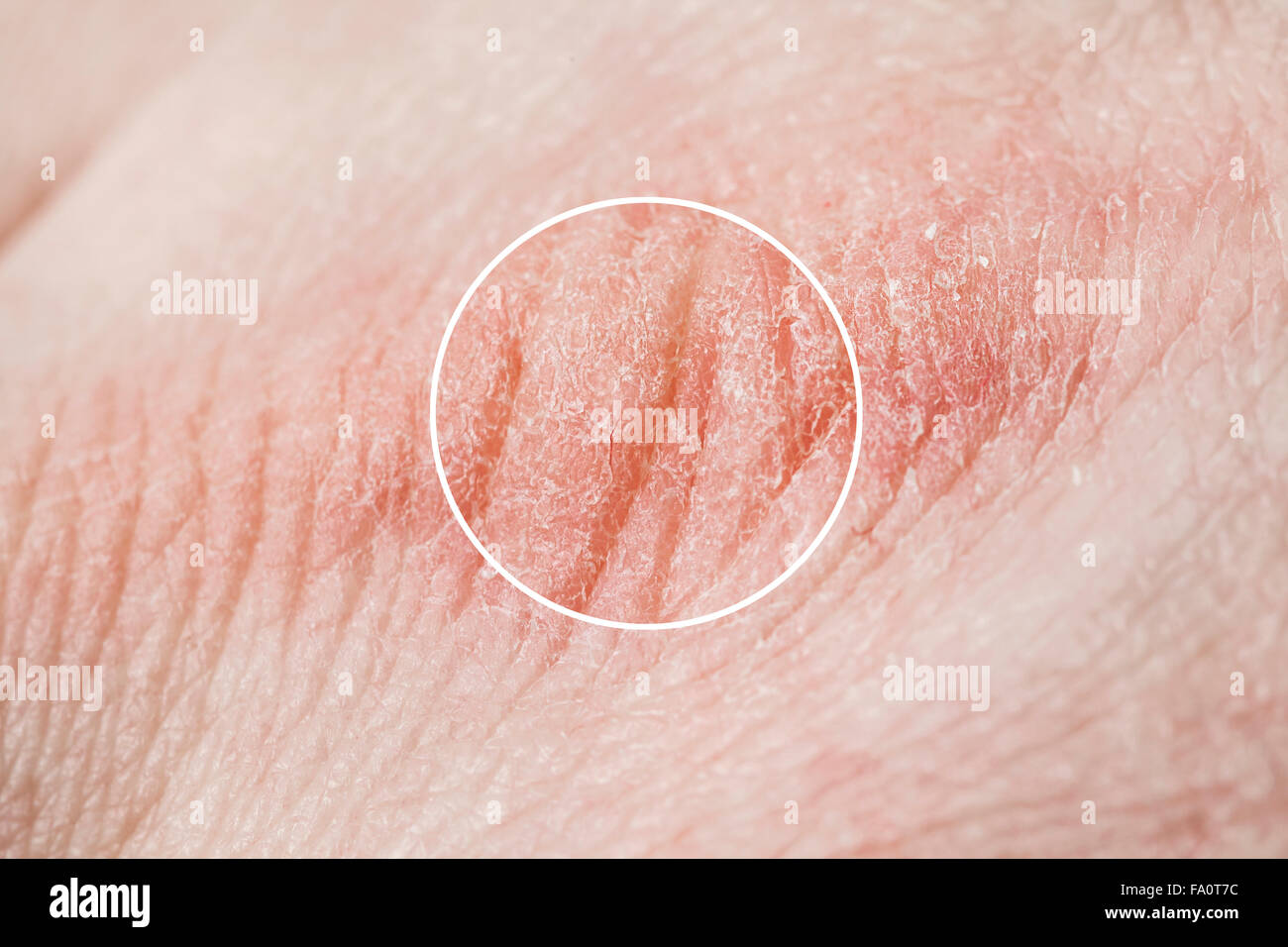 Scaly skin human hi-res stock photography and images - Alamy