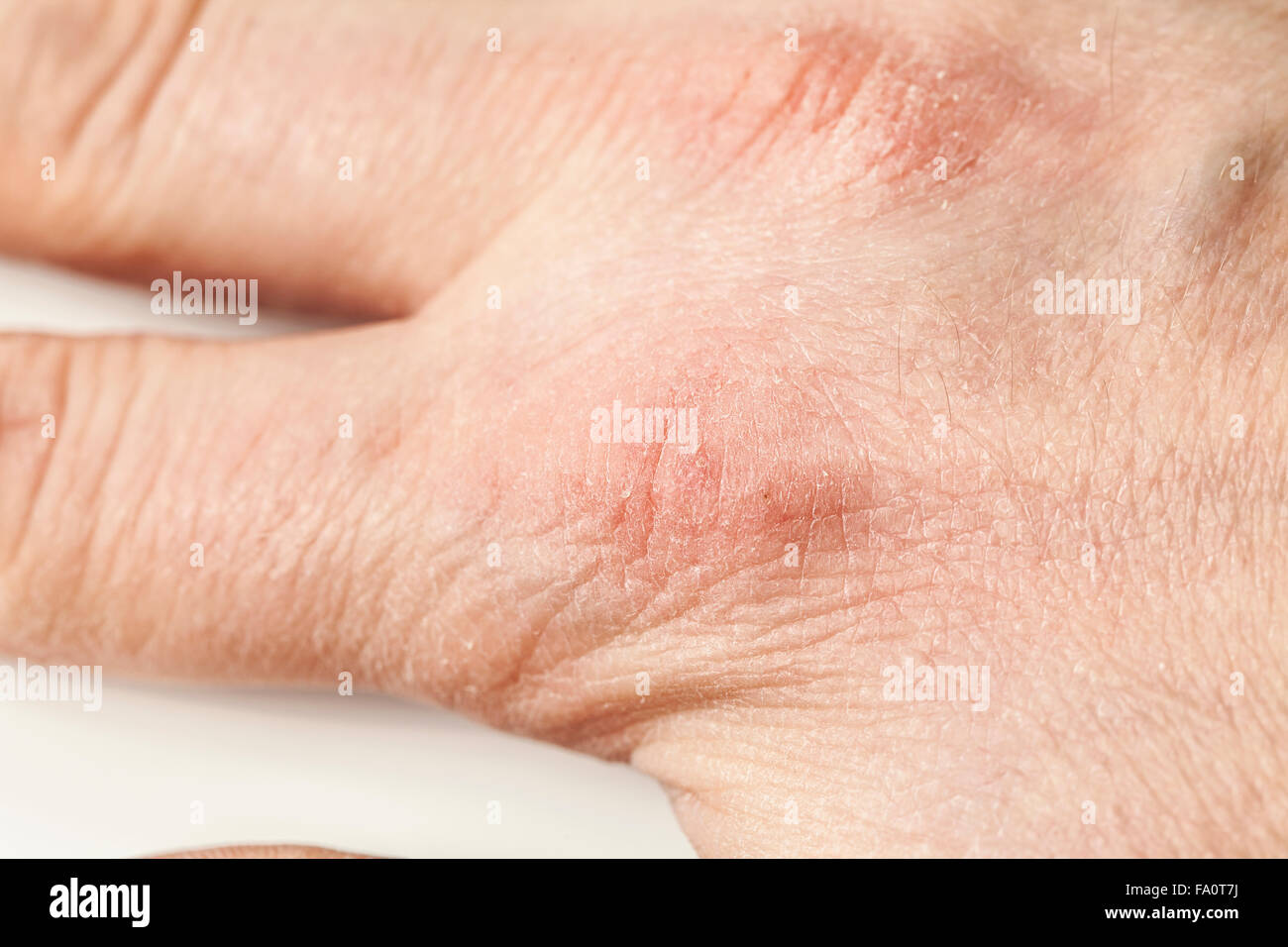 Hand with dry skin Stock Photo - Alamy