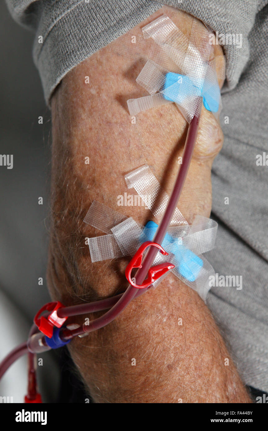 Fistula renal hi-res stock photography and images - Alamy