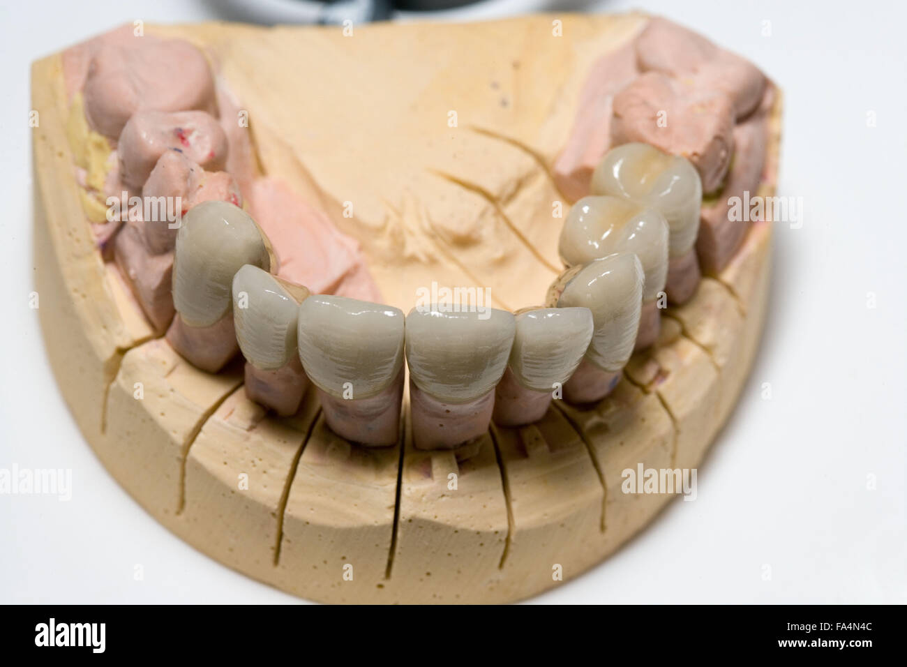 Dental impression of jaw with crown Stock Photo - Alamy
