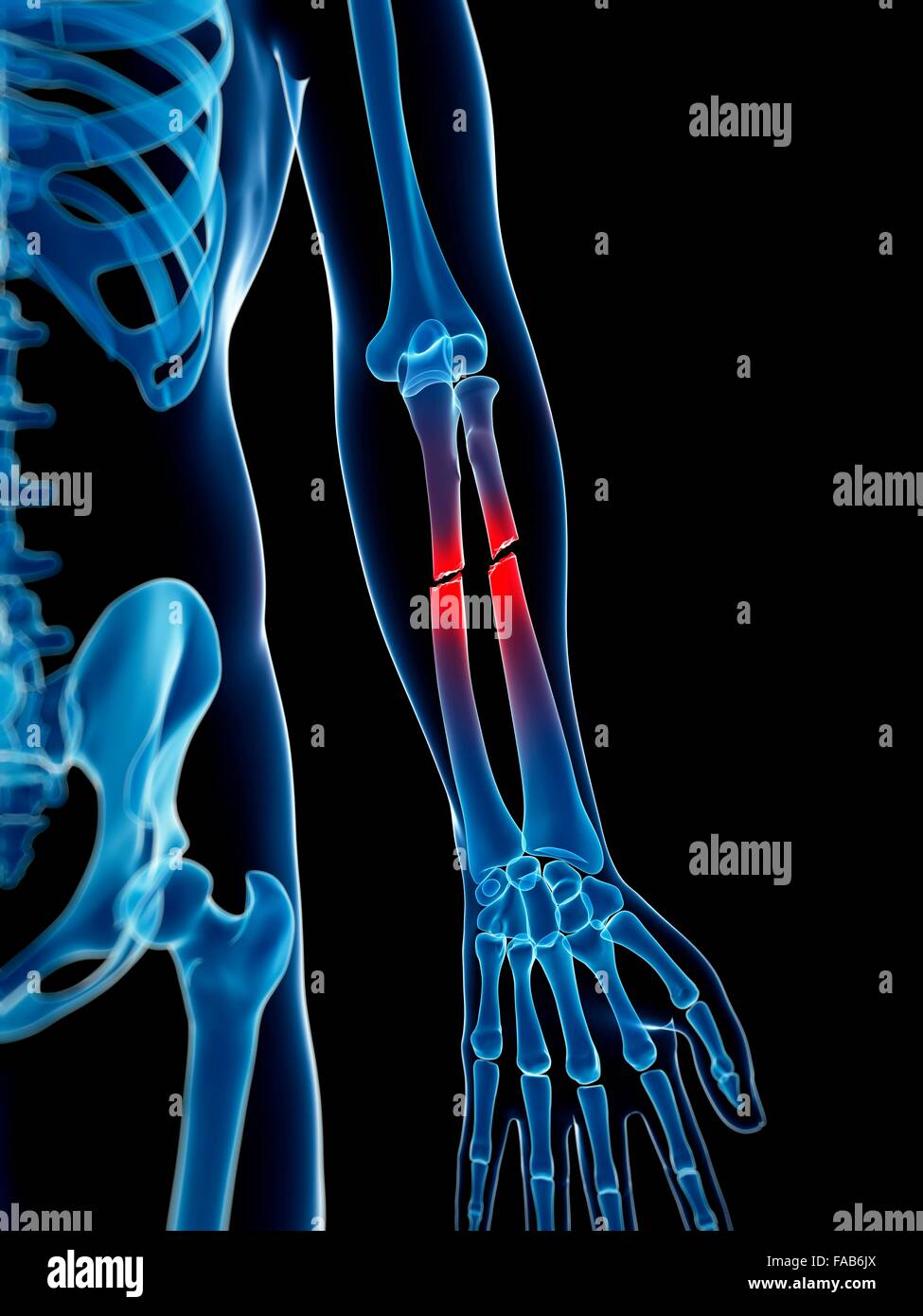 Broken radius hi-res stock photography and images - Alamy