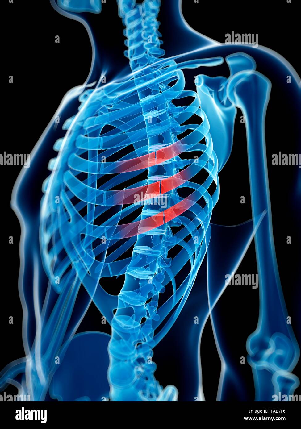 Broken ribs hi-res stock photography and images - Alamy