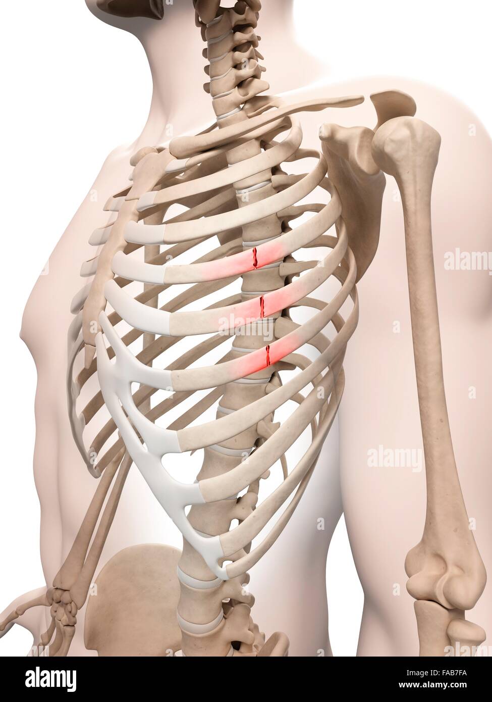 Broken ribs, computer illustration Stock Photo - Alamy