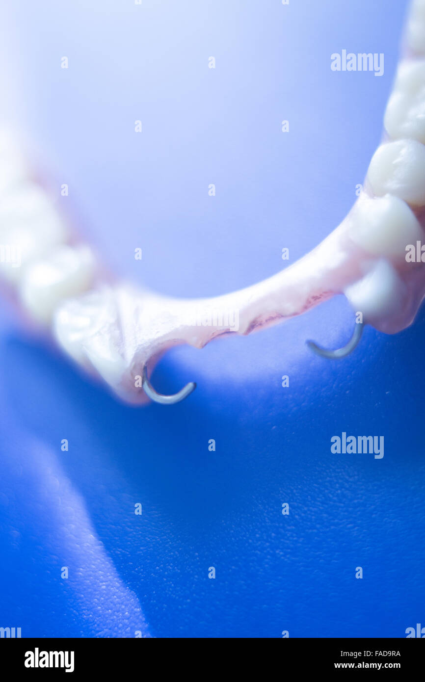 Removable partial denture metal and plastic dental false teeth ...