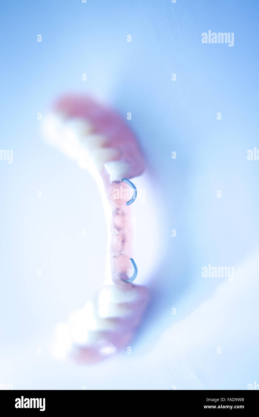 Removable partial denture metal and plastic dental false teeth ...