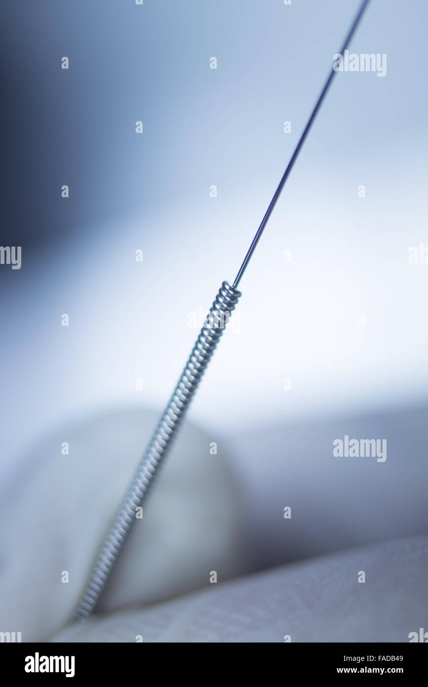 Acupuncture needle used for dry needling rehabilitation medical ...