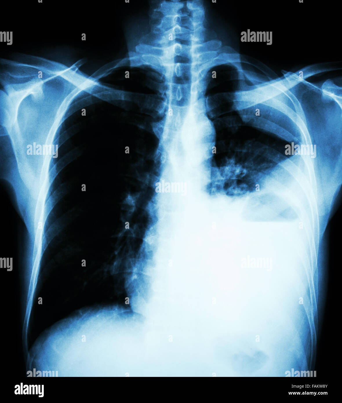 Lung cancer ( film x-ray of chest PA upright : show pleural effusion at ...