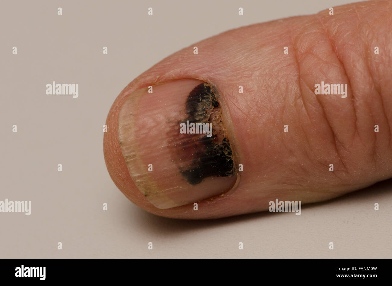Blackened nail hi-res stock photography and images - Alamy