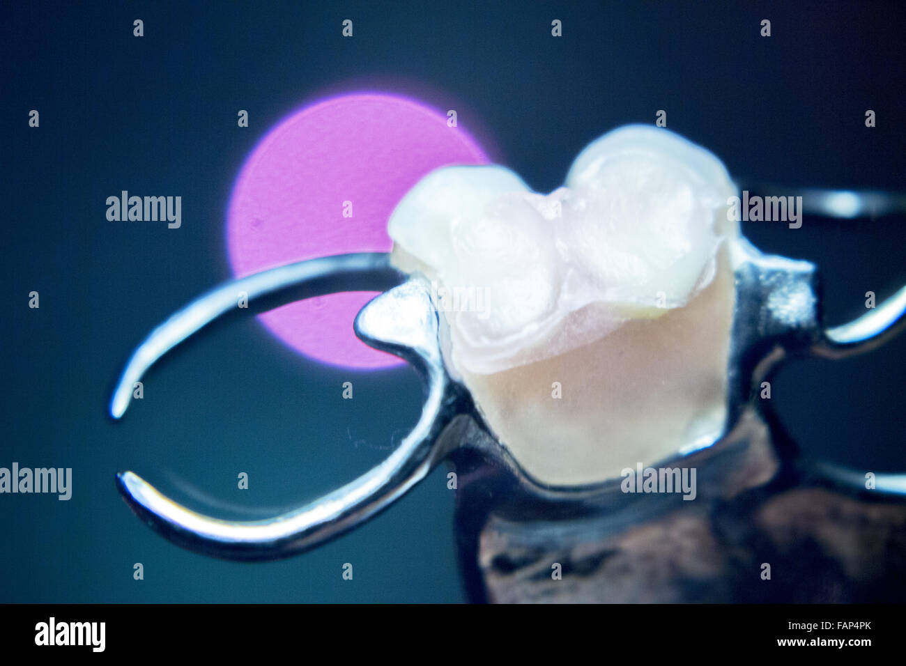 Removable partial denture metal and plastic dental false teeth ...