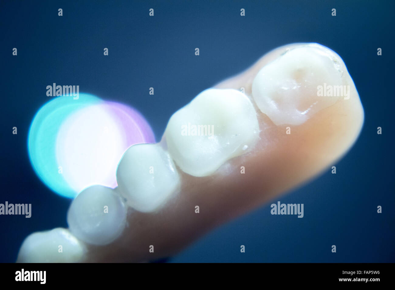 Removable partial denture metal and plastic dental false teeth ...