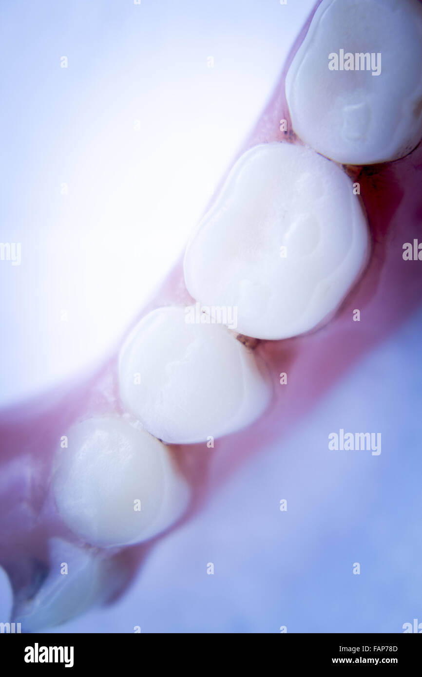 Removable partial denture metal and plastic dental false teeth ...