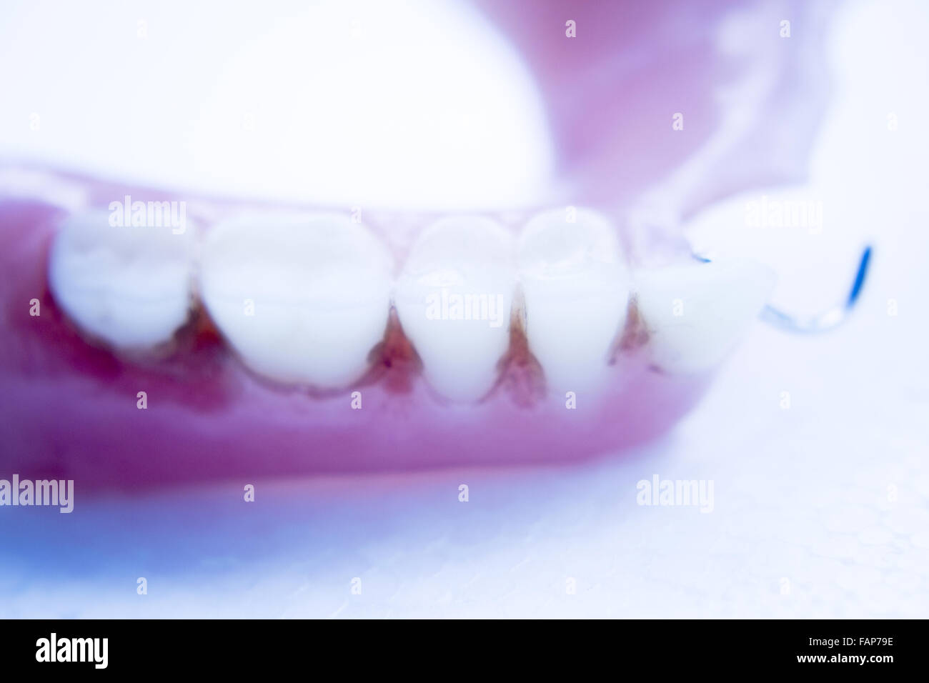 Removable partial denture metal and plastic dental false teeth ...