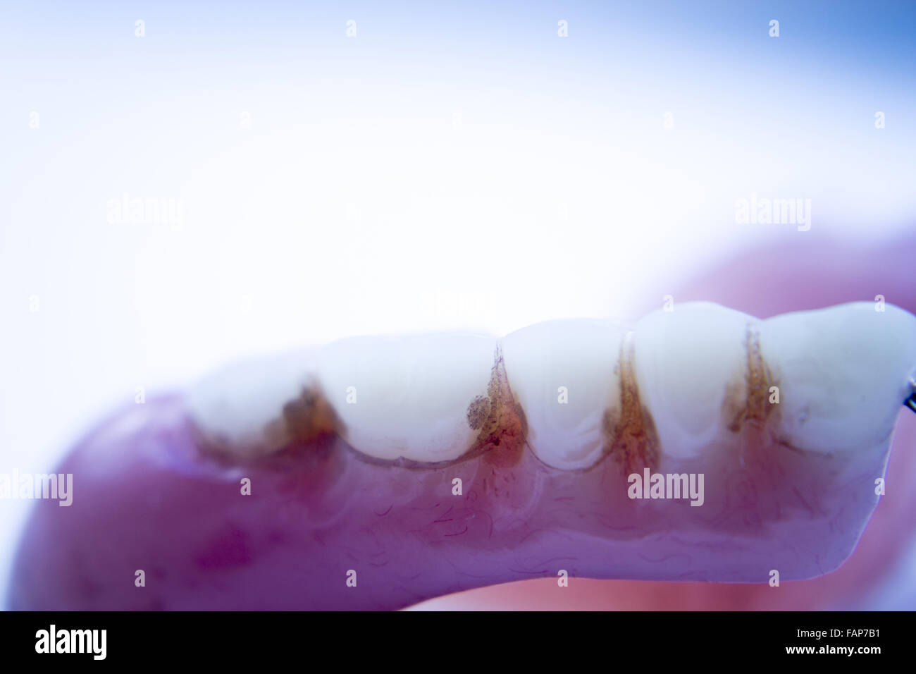 Removable partial denture metal and plastic dental false teeth ...