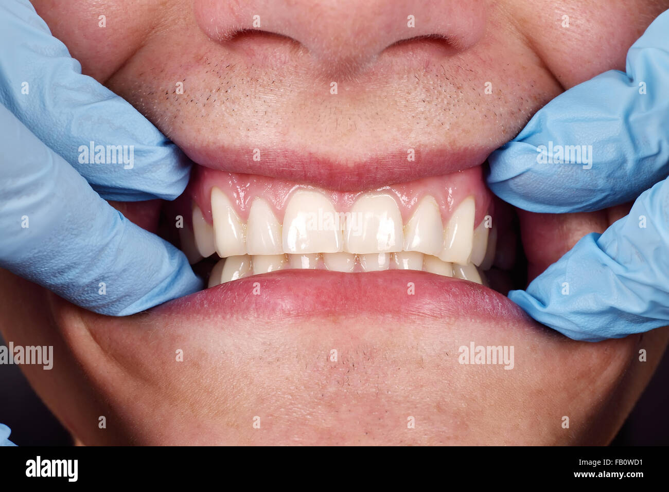 Dentist shows a patient's teeth, close up Stock Photo - Alamy