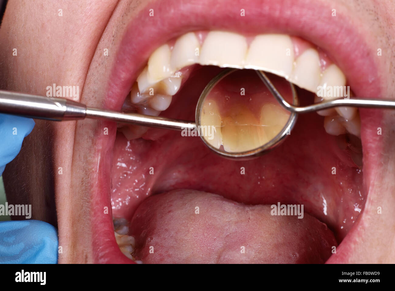 patient open mouth before oral inspection with hook and mirror near by ...