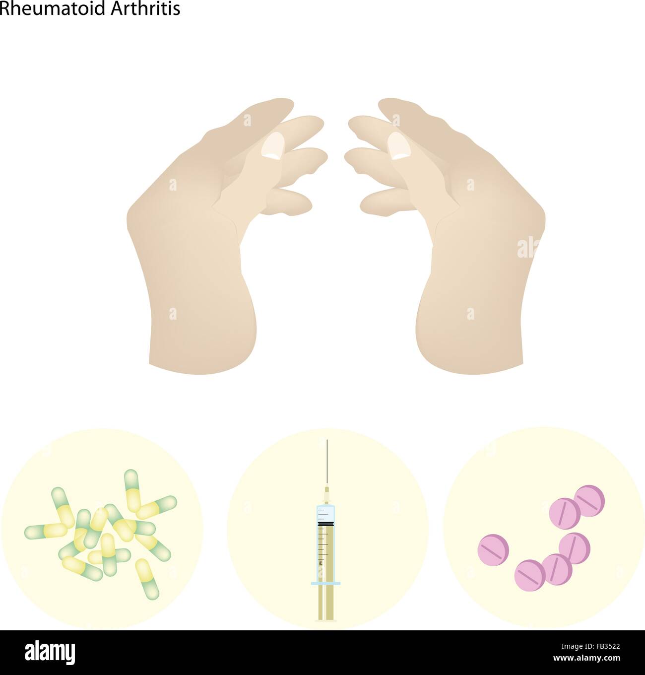 Medical Concept, Illustration of Rheumatoid Arthritis of Bone and ...