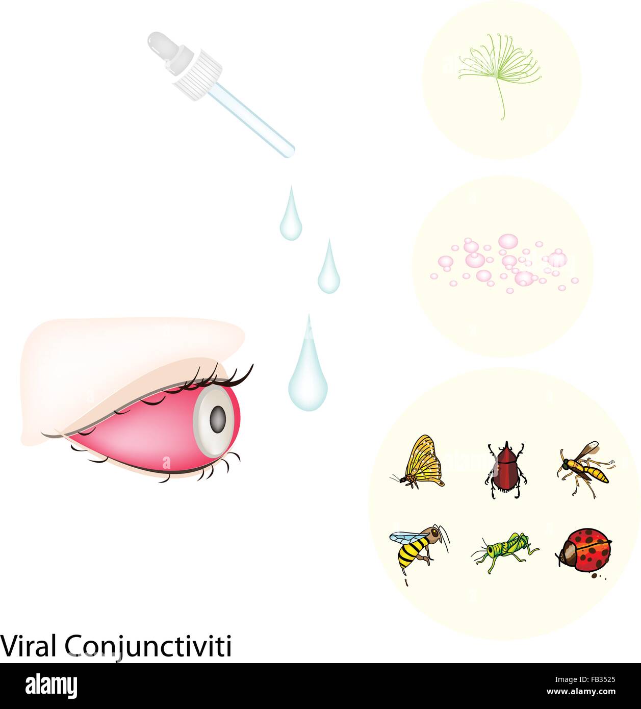 Viral Conjunctivitis Follicles
