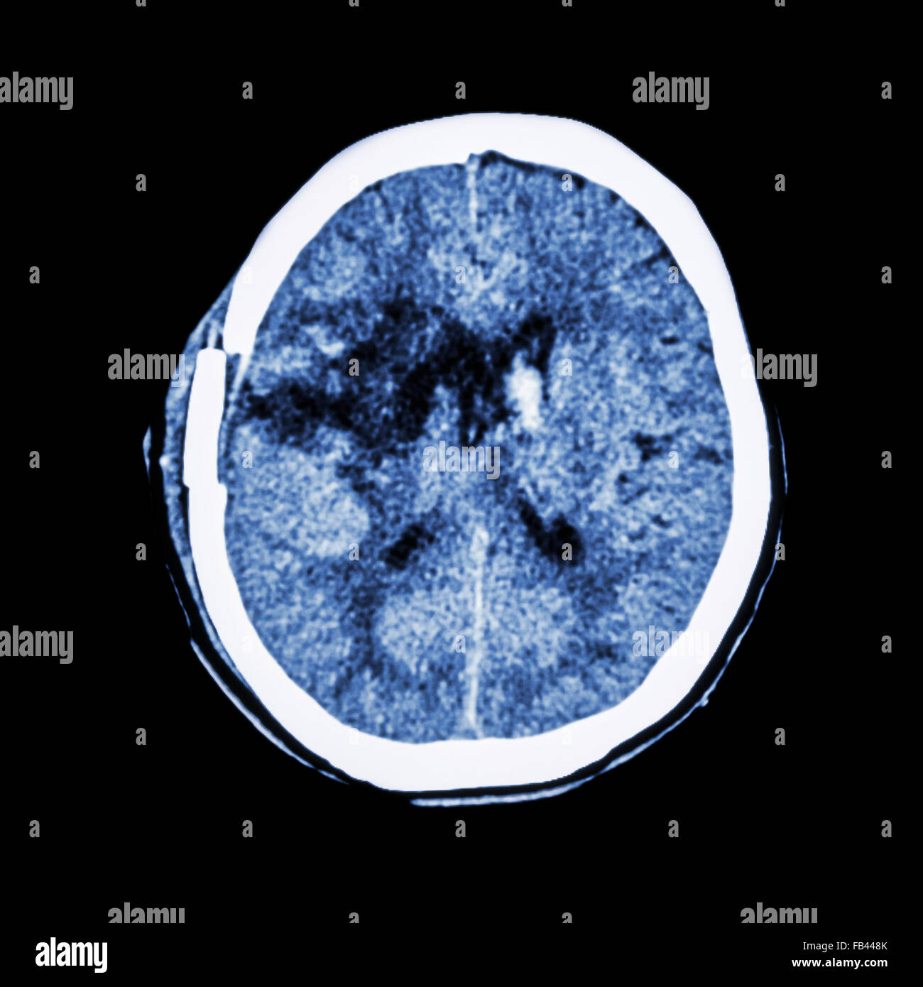 CT scan of brain : show old right basal ganglia hemorrhage with brain ...