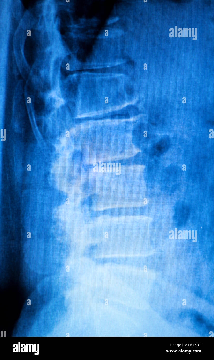 Painful neck and spine injury x-ray scan Traumatology and orthopedics ...