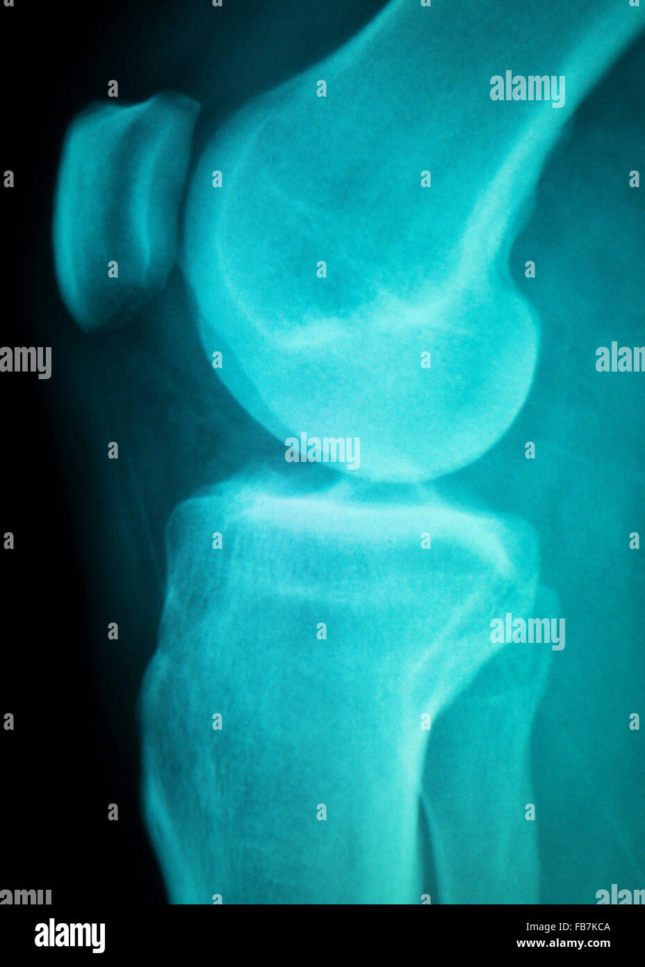 Knee joint meniscus x-ray test scan results photo showing injury and ...