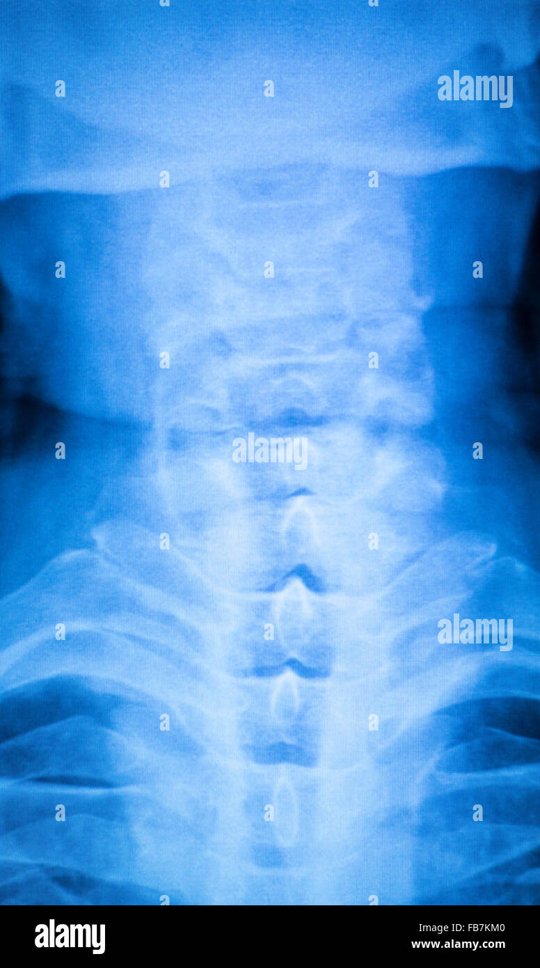 Painful neck and spine injury x-ray scan Traumatology and orthopedics ...