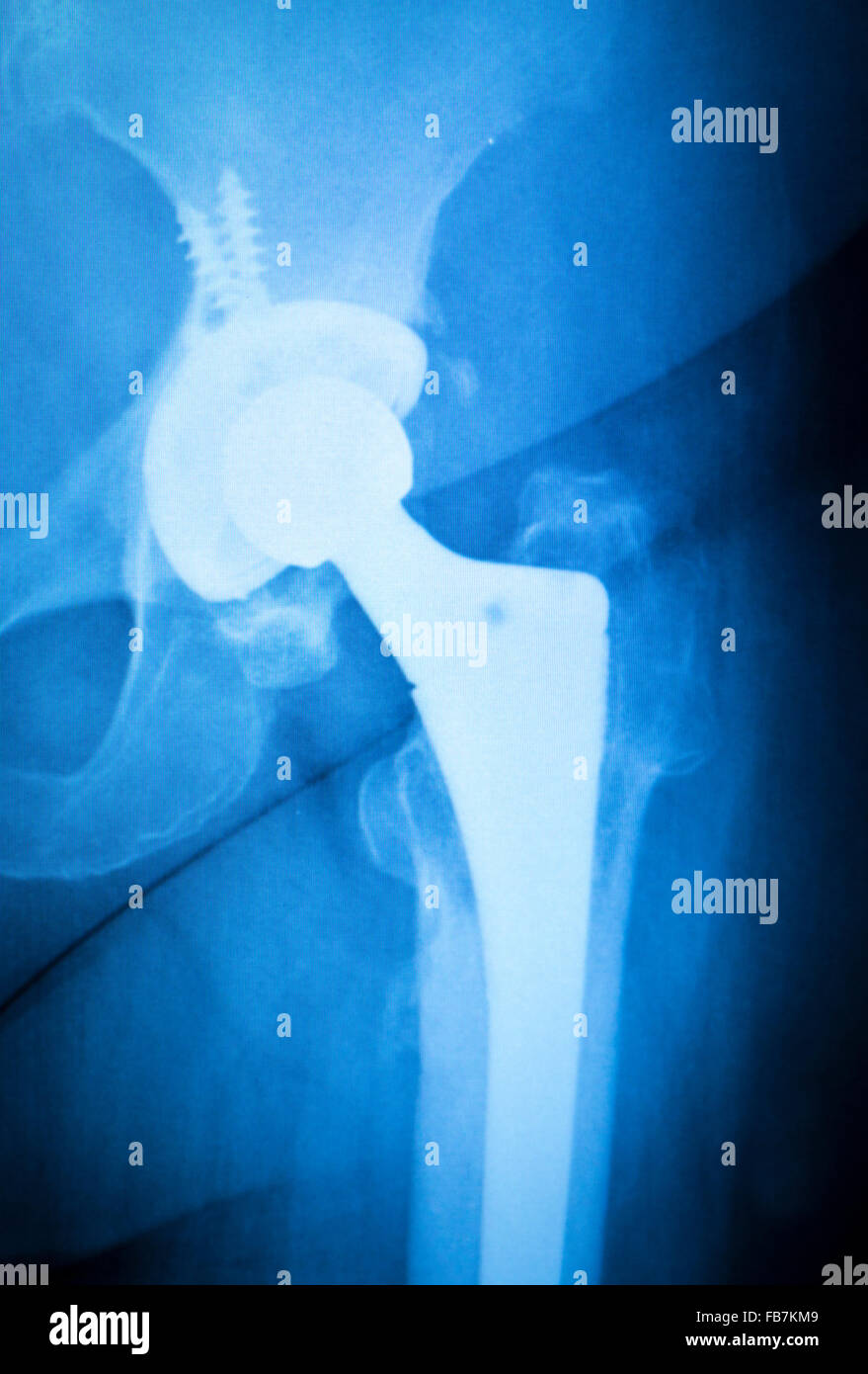 Orthopedic hip plate and bone screw hi-res stock photography and images ...