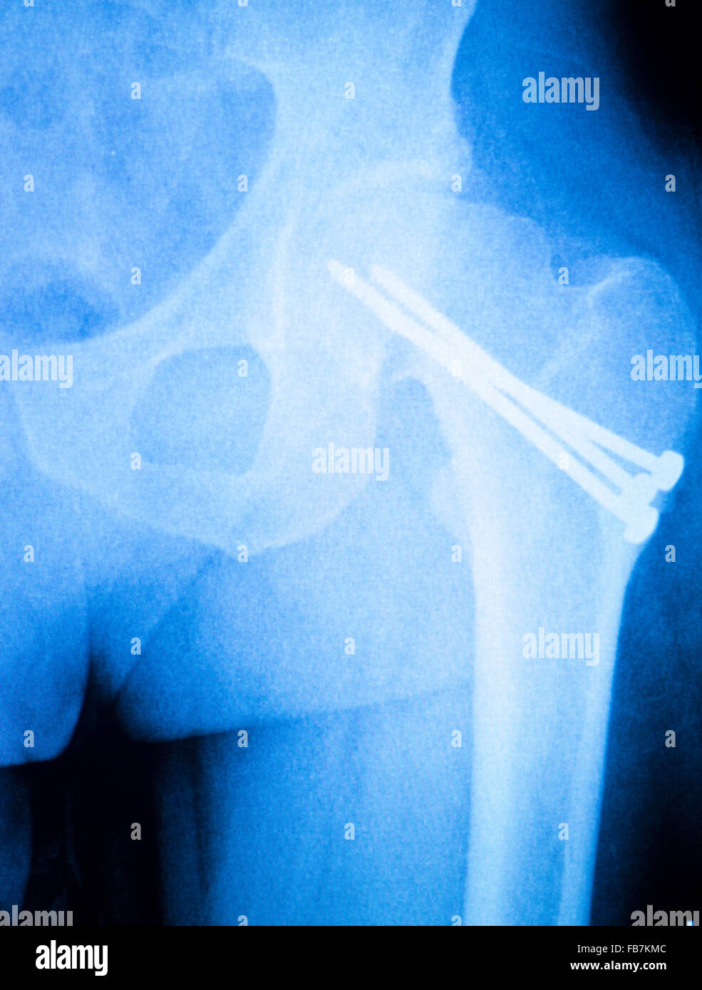 Orthopedic hip plate and bone screw hi-res stock photography and images ...