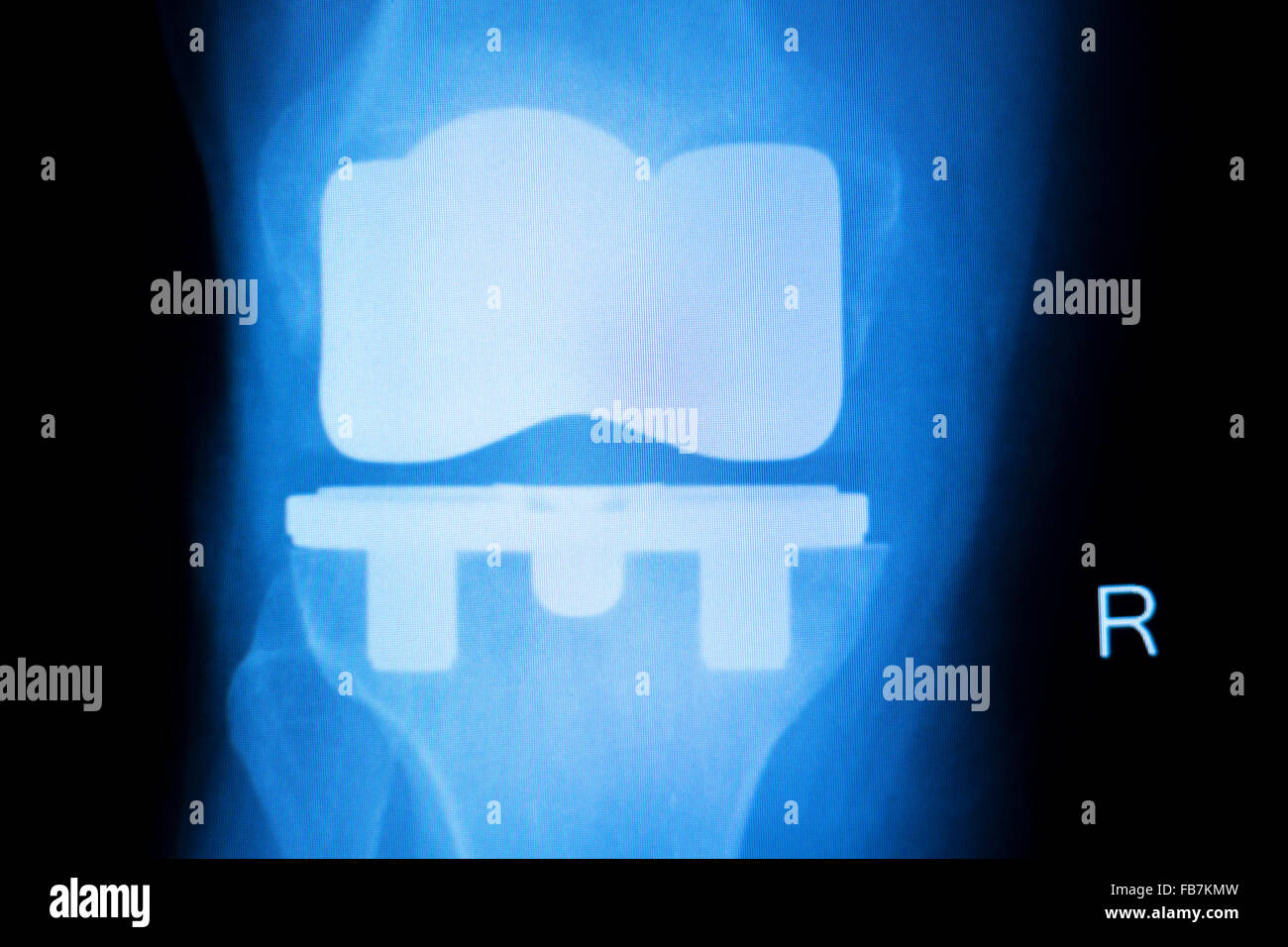 Knee joint meniscus x-ray test scan results photo showing injury and ...