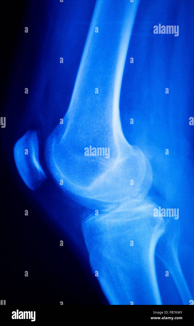 Knee joint meniscus x-ray test scan results photo showing injury and ...