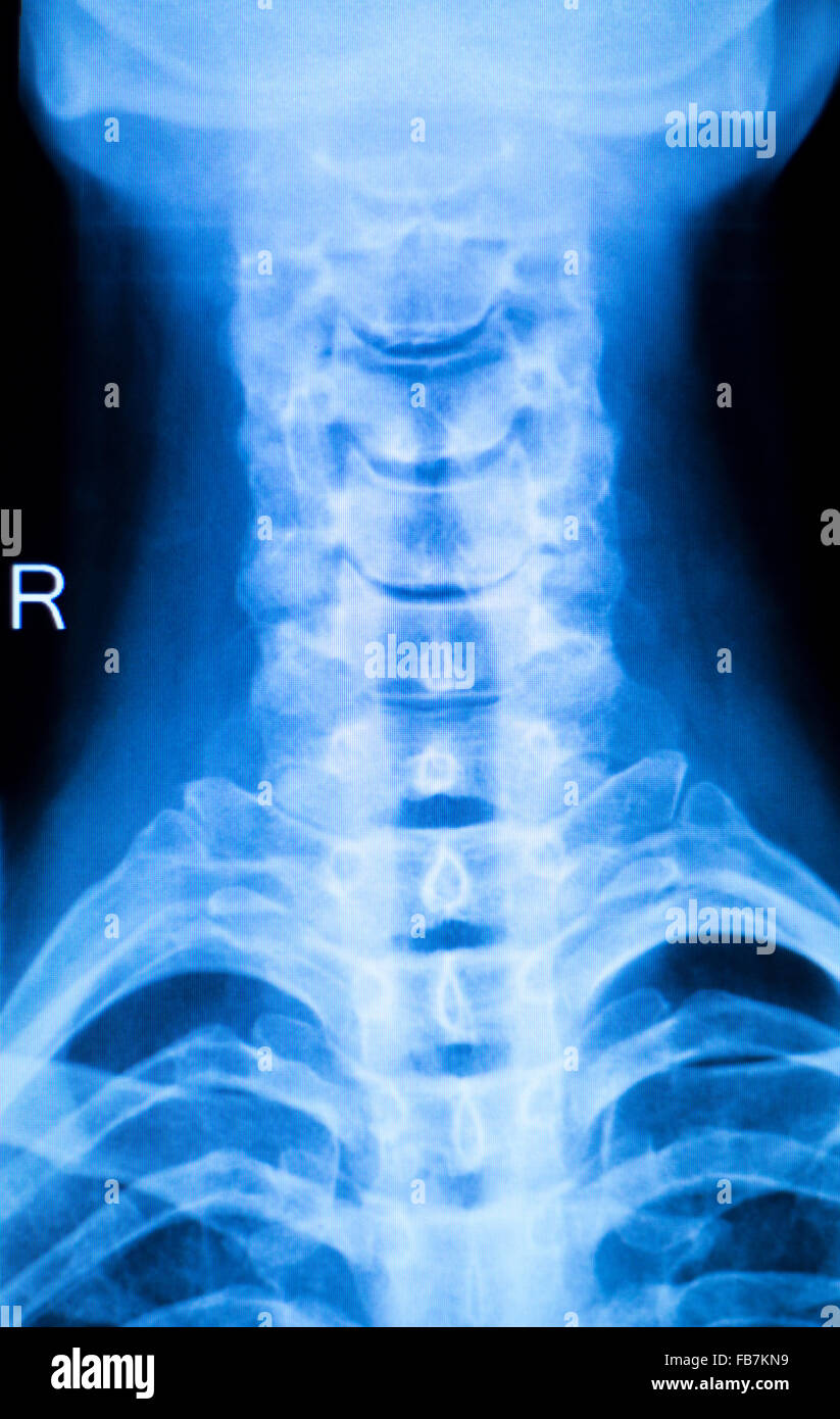 Painful neck and spine injury x-ray scan Traumatology and orthopedics ...