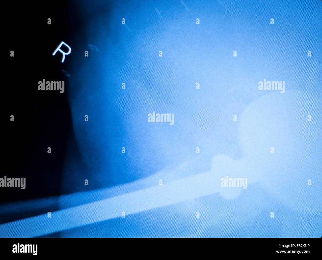 Arthritic hip xray test scan orthopedic and Traumatology results ...