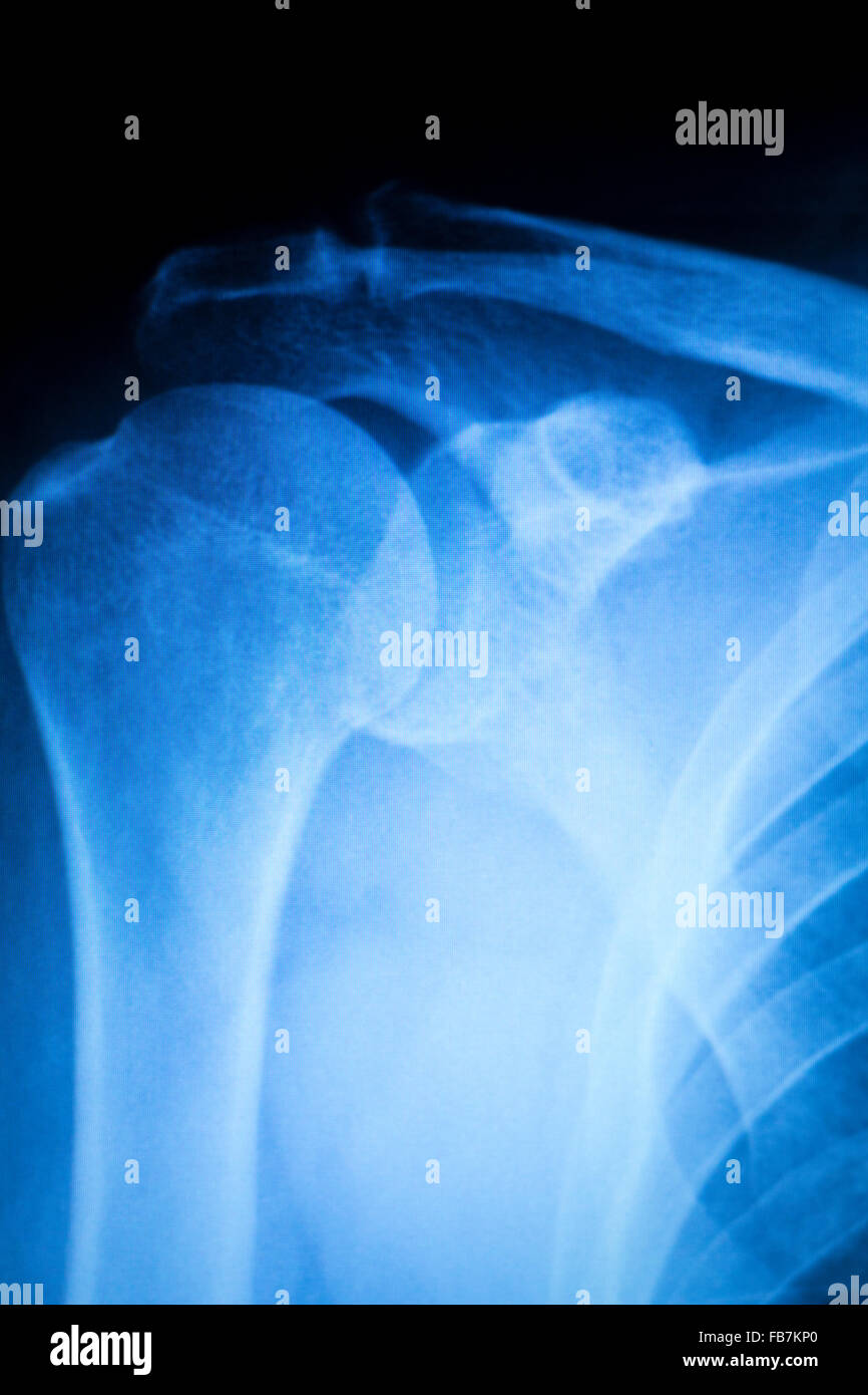 Shoulder injury orthopedics xray scan Trauamtology scanning results ...