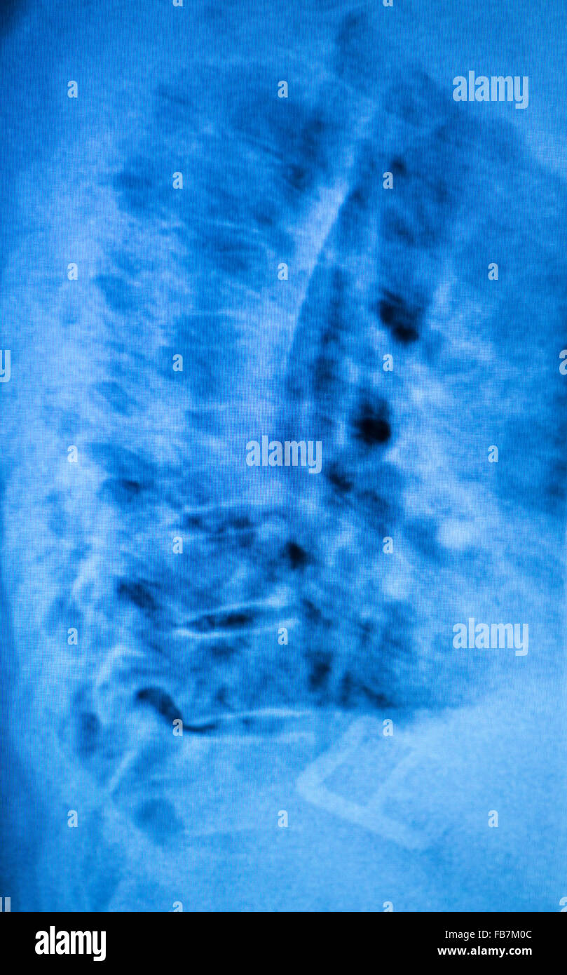 Painful neck and spine injury x-ray scan Traumatology and orthopedics ...