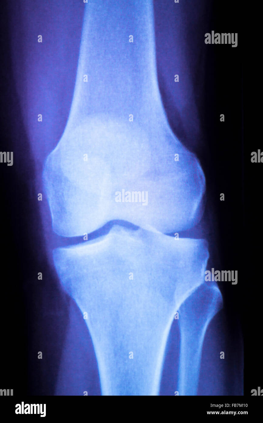 Knee joint meniscus x-ray test scan results photo showing injury and ...
