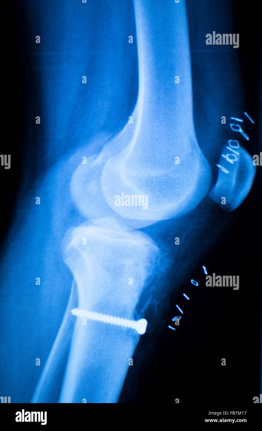 Knee joint meniscus x-ray test scan results photo showing injury and ...