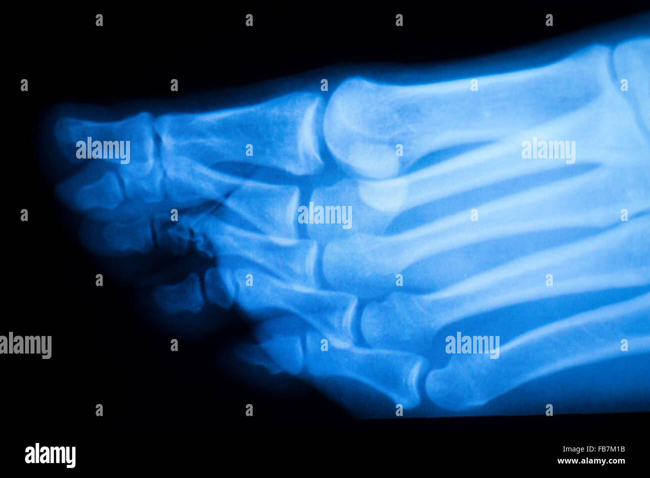 Foot and toes injury x-ray scan orthopedics and Traumatology radiology ...