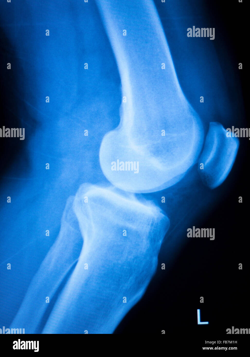 Knee joint meniscus x-ray test scan results photo showing injury and ...