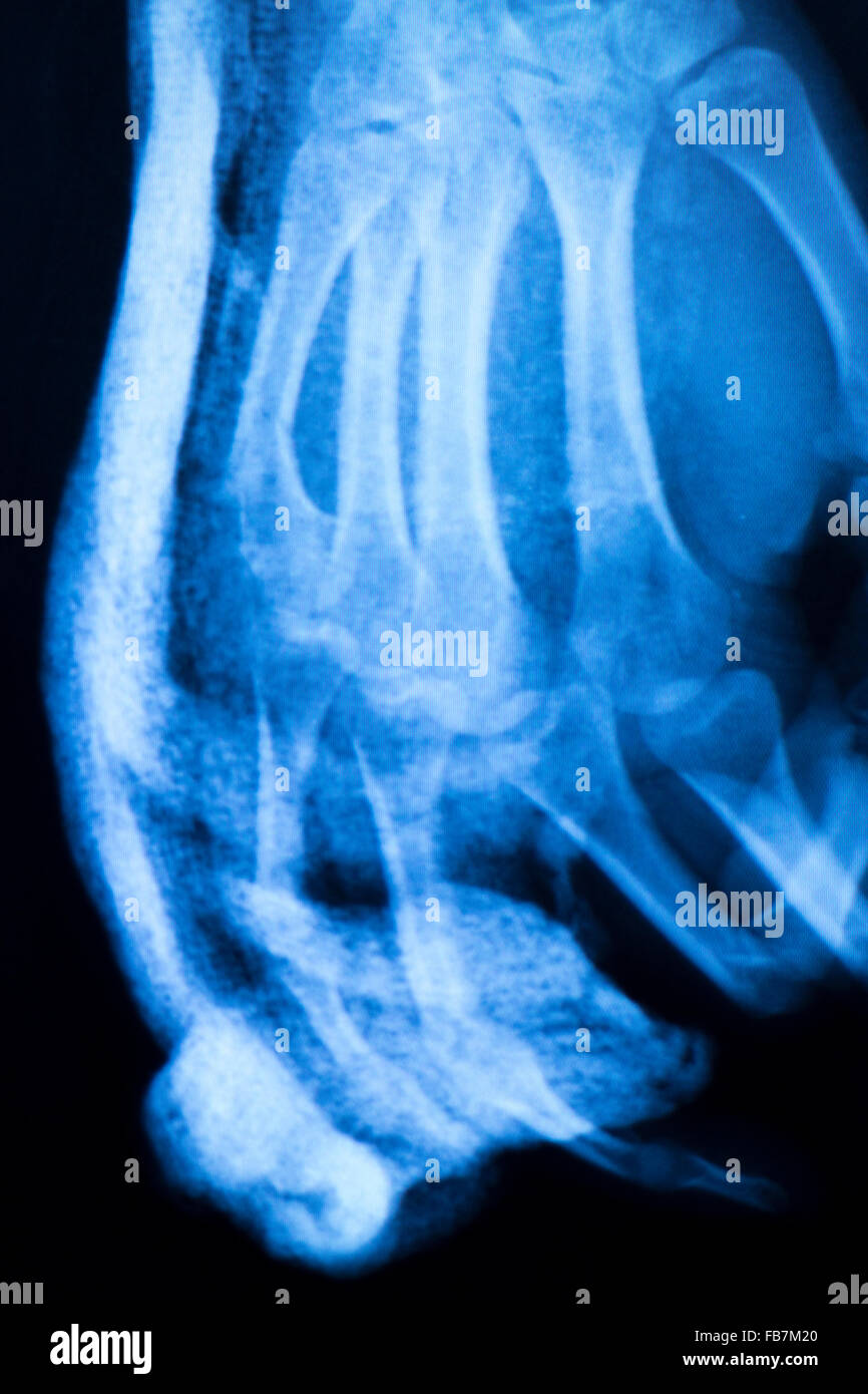 Foot and toes injury x-ray scan orthopedics and Traumatology radiology ...