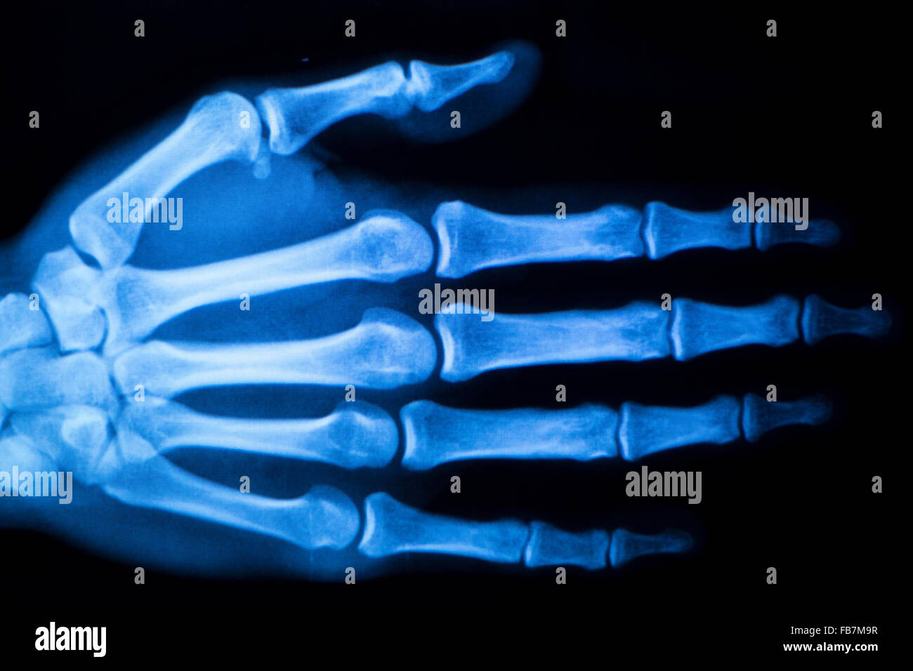 Hand, fingers and thumb hospital x-ray scan test results for joint pain ...