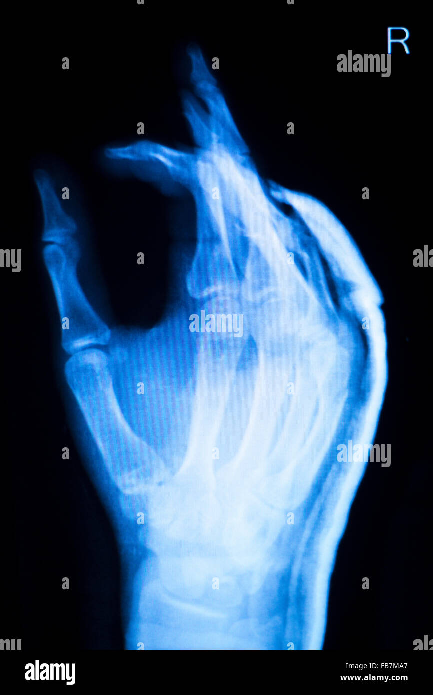 Hand, fingers and thumb hospital x-ray scan test results for joint pain ...