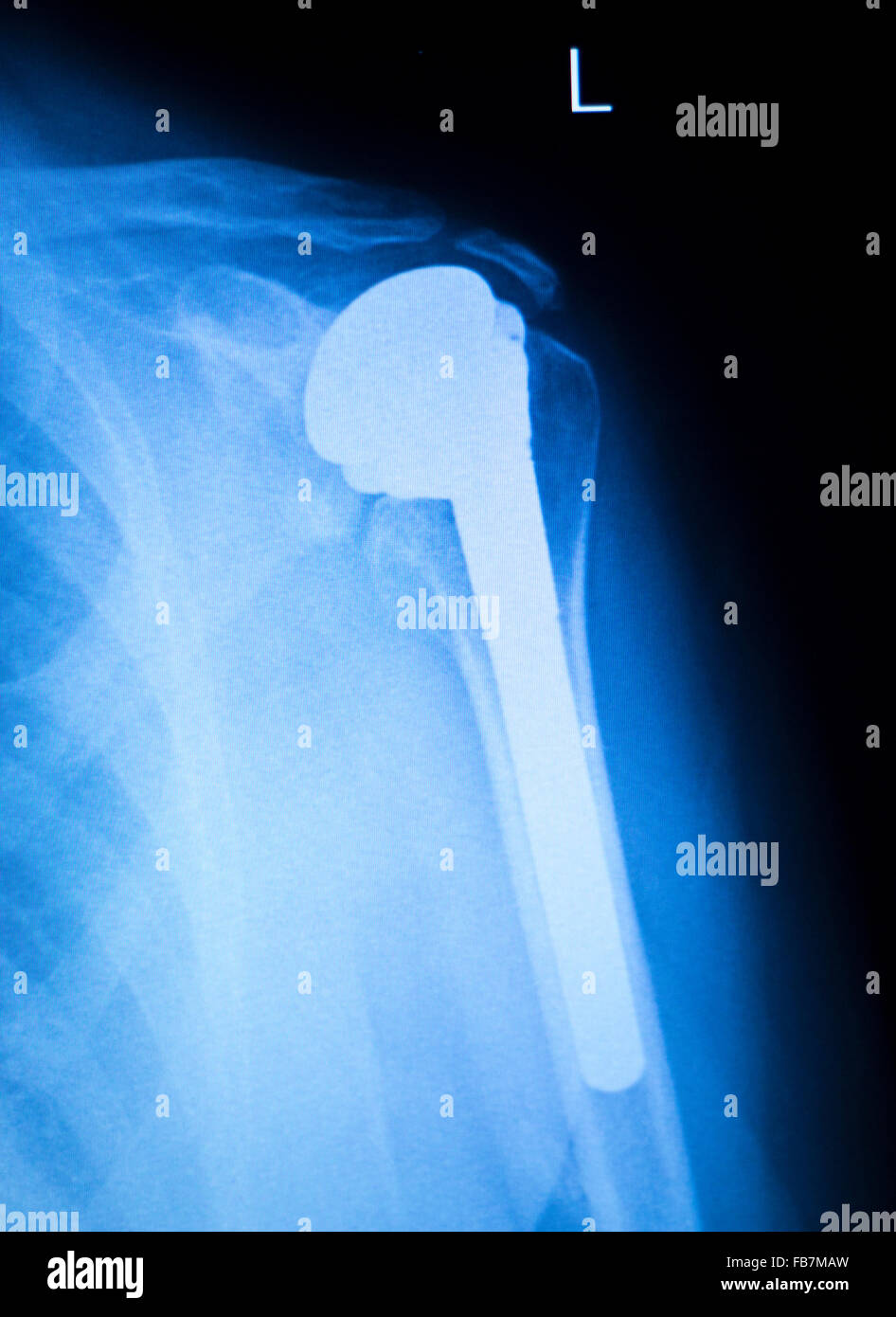 Shoulder xray plate hi-res stock photography and images - Alamy
