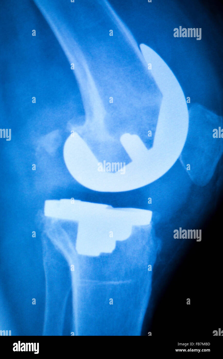 Knee joint meniscus x-ray test scan results photo showing injury and ...