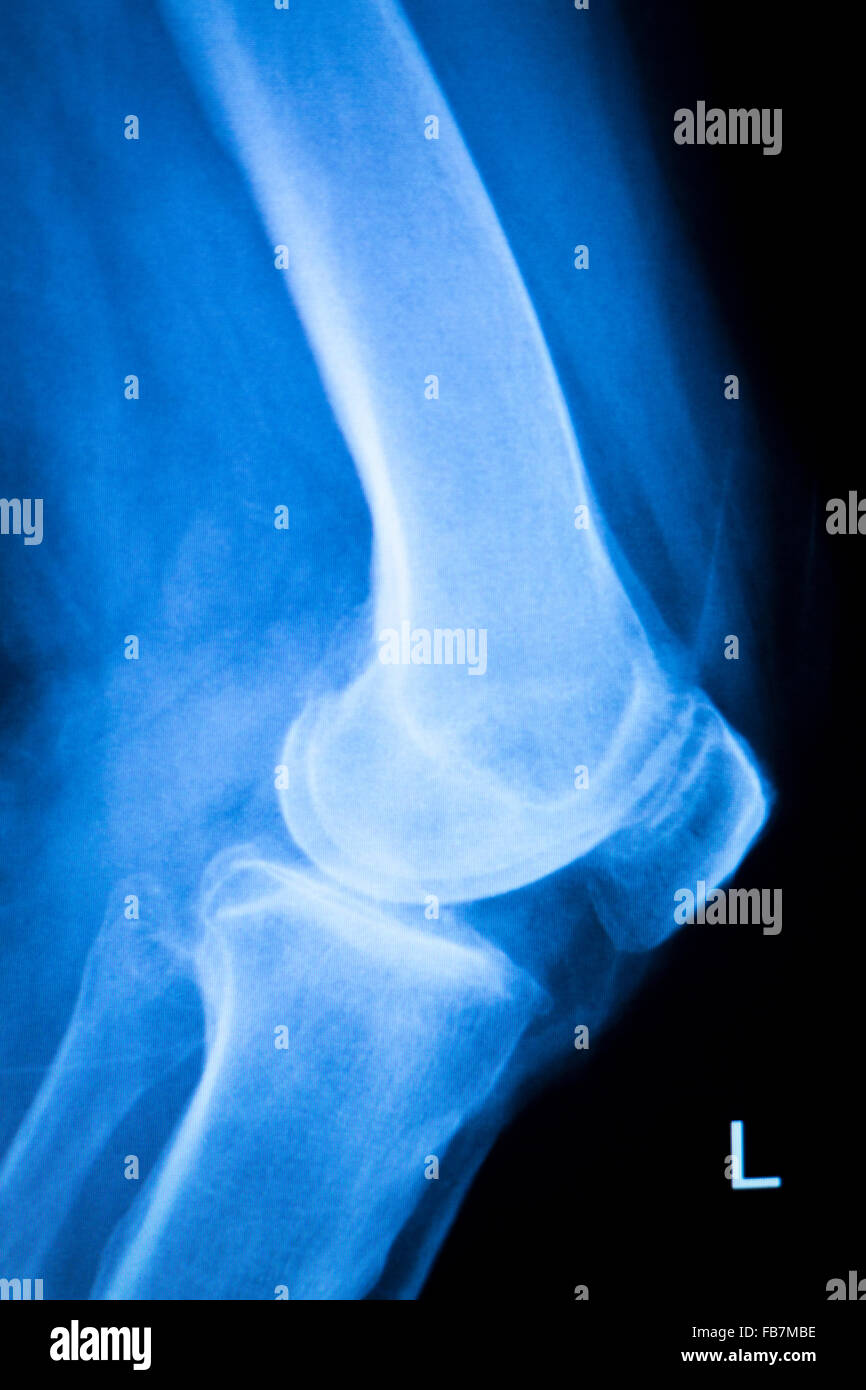 Knee joint meniscus x-ray test scan results photo showing injury and ...