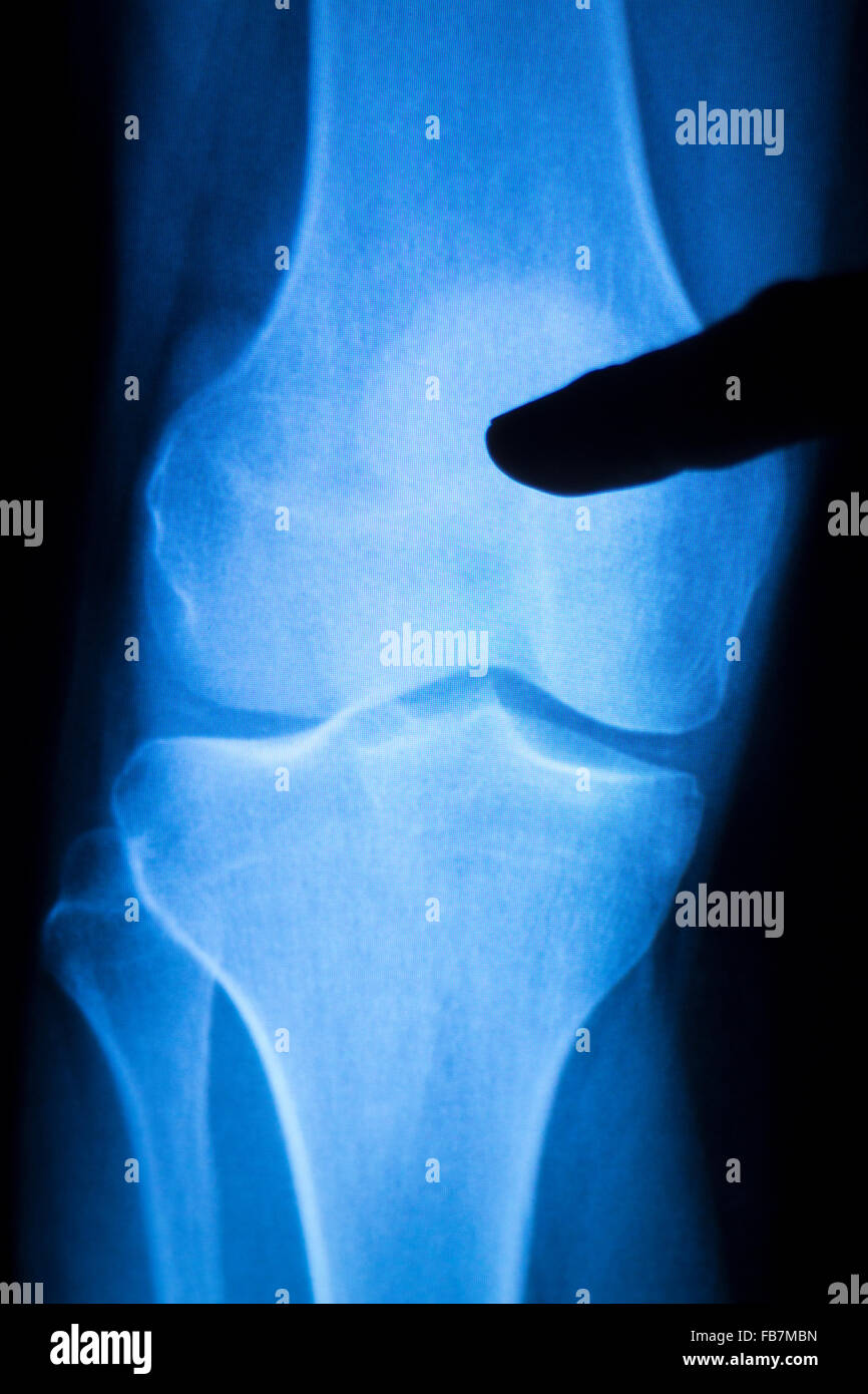 Knee joint meniscus x-ray test scan results photo showing injury and ...
