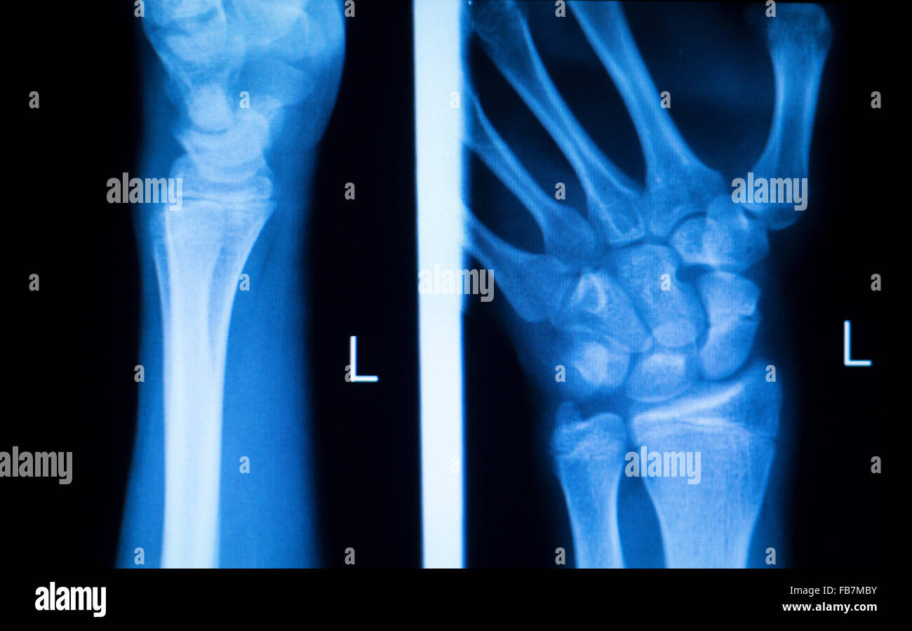 Hand, fingers and thumb hospital x-ray scan test results for joint pain ...